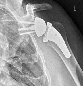 Reverse Total Shoulder Replacement - Nathan Faulkner, MD - Denver, CO