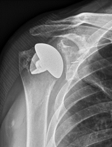Anatomic Total Shoulder Replacement - Nathan Faulkner, MD - Denver, CO