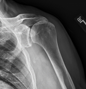 Rotator Cuff Arthropathy - Nathan Faulkner, MD - Denver, CO